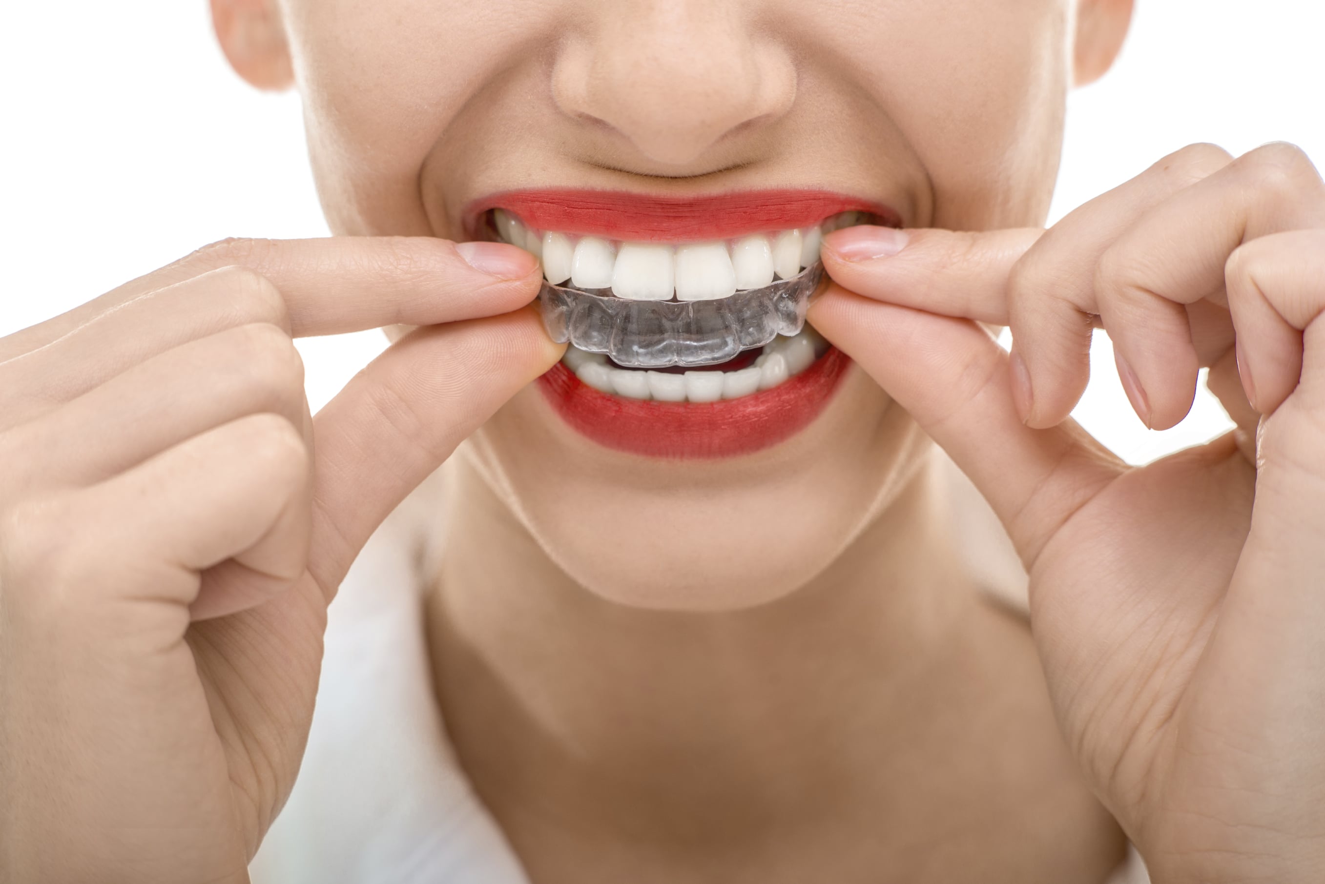 Invisalign Leamington | Dentist Chatham | Dental Implants